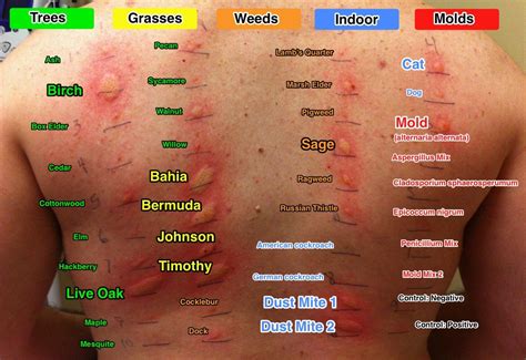 Mould Allergy Symptoms Uk At Keith Maxey Blog