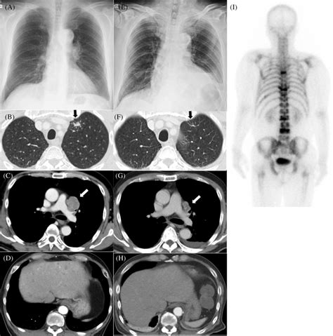 Chest X Ray Of The Lung A Nodule In The Lung On Computed Tomography Download Scientific