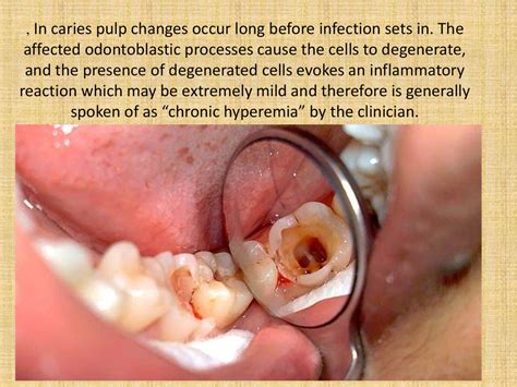 Pulp Involvement Online Presentation