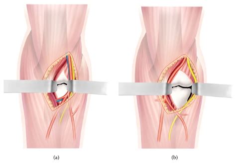 A Modified Anteromedial Approach For Exposure Of Coronoid Fractures An
