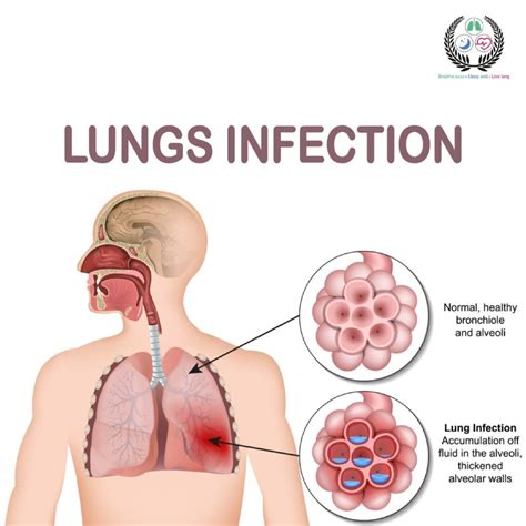 What Does A Bacterial Chest Infection Feel Like At Susan Villanueva Blog