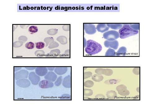 Malaria An Overview Of Lifecycle Morphology And Clinical
