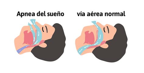 Apnea Obstructiva Del Sueño Y Problemas Para Dormir Tena