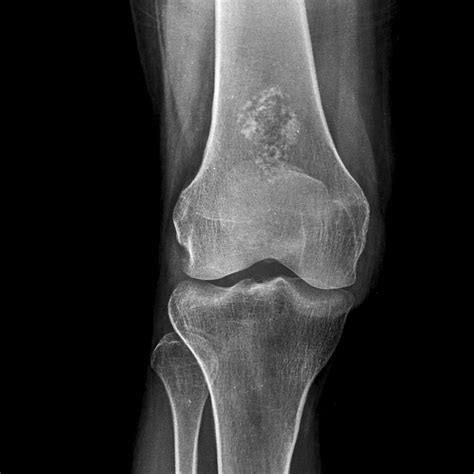 Enchondroma X Ray Radiology Case Enchondroma Mri X Rays Ct