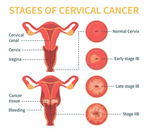 Cervical Ectropion Stock Illustrations 5 Cervical Ectropion Stock Illustrations Vectors