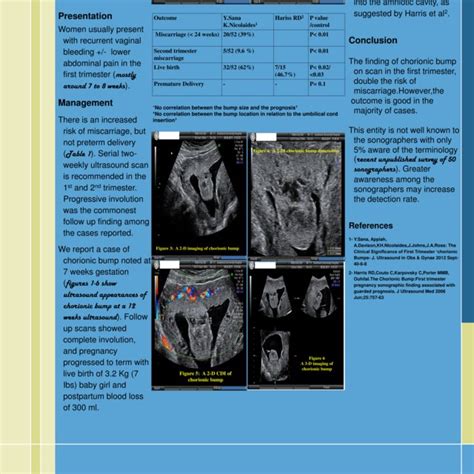 Pdf Chorionic Bump Off The Beaten Path First Trimester Sonographic Finding