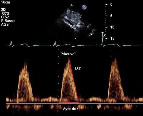 Echocardiographic Nomograms For Upper Abdominal Aorta Doppler Systolic