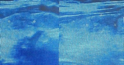 Img Found On Phone May Have Been Other Lobe As Images Were Swapped