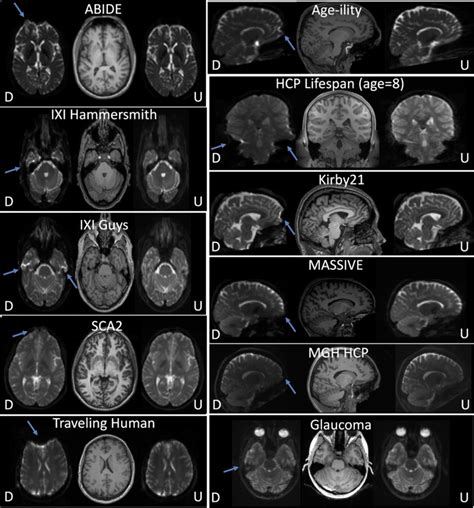 Distortion Correction Of Diffusion Weighted Mri Without Reverse Phase