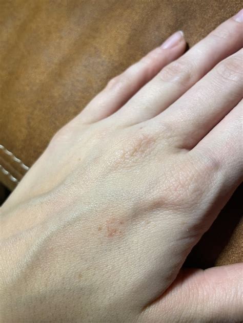 Post Scabies Eczema Rscabies