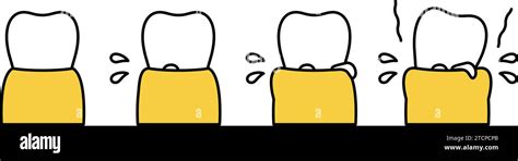Illustration Of Periodontal Disease Progression Image Simple Line Drawing Vector Illustration