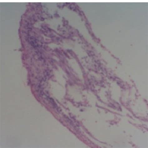 Pdf Determination Of Pulp Necrosis Based On Periapical Digital