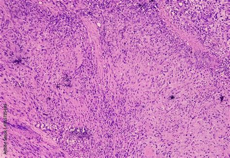 Bone Cancer Chondroblastic Osteosarcoma Its Very Rare Cancer