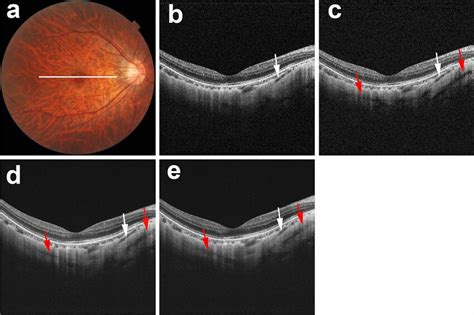Scleral Vessel Artifacts In Polarization Dependent Oct Images And Download Scientific Diagram