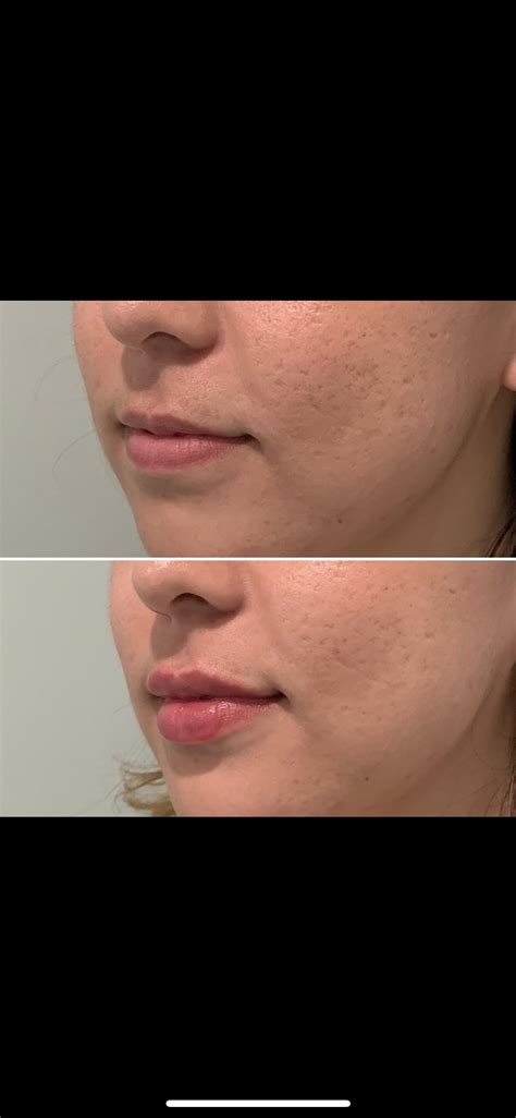Before And After Lip Filler Plus Masseter Botox Plasticsurgery