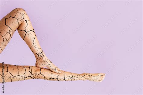 Dry Skin Of The Body Beautiful Slender Female Legs With Cracked Skin