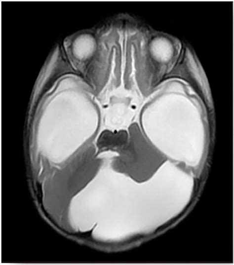 A Rare Presentation Of Dandy Walker Syndrome With Meningitis Symptoms