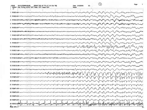 Electrocorticography PPT Brain And Nervous System Disorders Diseases And Conditions