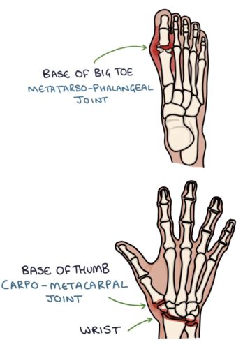 Gout And Pseudogout Flashcards Quizlet