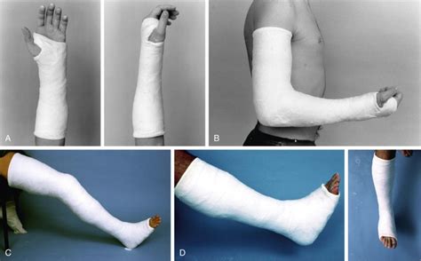 Closed Fracture Management Musculoskeletal Key