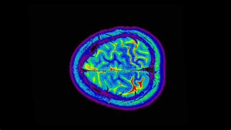 Mri Brain Scan Magnetic Resonance Image Ct Scan Of Human Brain In