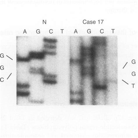 Direct Genomic Sequence Analysis Of The P53 Gene In The Cases Shown In Download Scientific