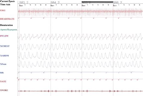 Patient With Mild Sleep Apnea Demonstrating Hypoxemia During A Portion Download Scientific