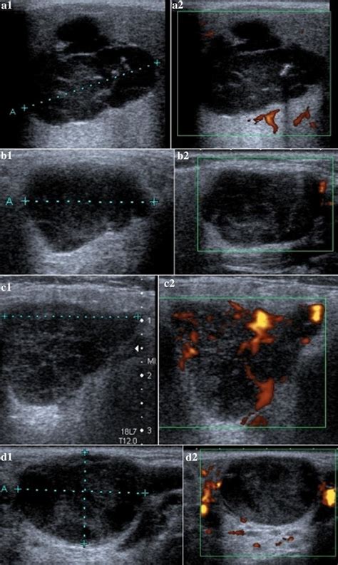 Us Of Different Pleomorphic Adenomas A1 A2 Polycyclic Shape Highly