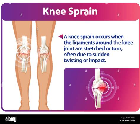 Illustration Of Knee Sprain Symptoms And Causes Stock Vector Image