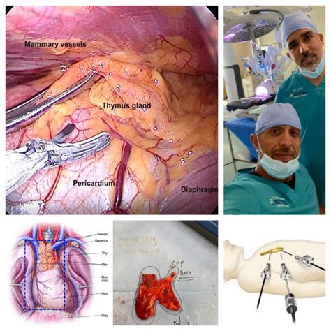 Successfull First Thoracoscopic Minimally Invasive Thymectomy American