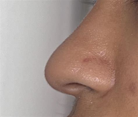 Removed Nose Piercing Scar Hypertrophic Hyperpigmentation Etc