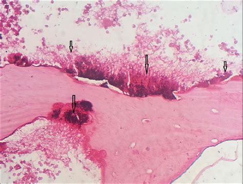 Actinomycotic Osteomyelitis Indian Journal Of Dermatology