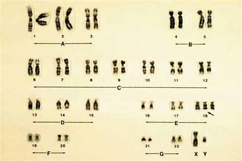 Imagetrisomy 18 Karyotype Merck Manual Professional Edition