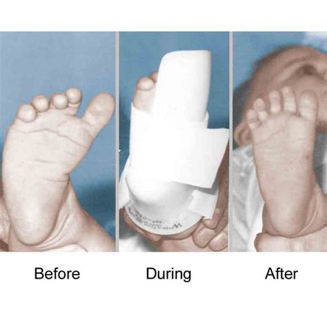 Wheaton Ctev Brace And Wheaton Mta Brace Wheaton Brace Ctev 9 15 Mo
