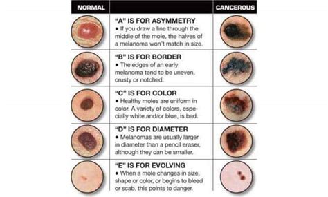 A Mole Turns Into Scab