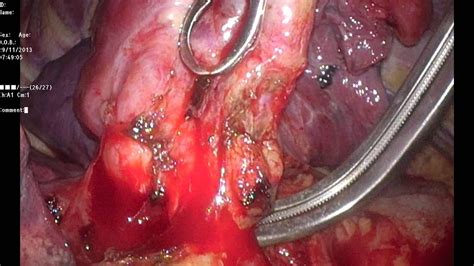 Vats Lobectomy For Bronchiectasis Youtube