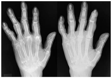 Trends In Rheumatoid Hand Surgery Indications Techniques And Outcomes