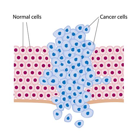 Breast Cancer Cells Vs Normal Cells