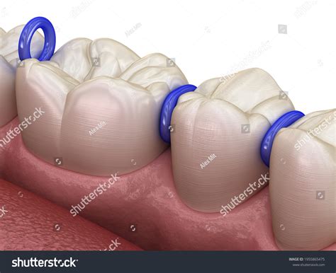 Rubber Separator Between Teeth Preparation Braces Stock Illustration
