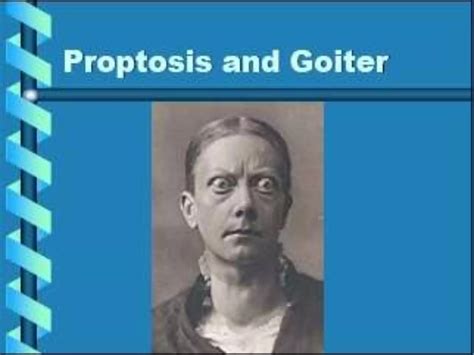 Thyroid Disorders Ppt