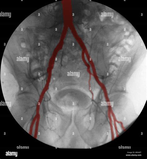 Internal Iliac Anatomy Angiogram At Henry Alfred Blog