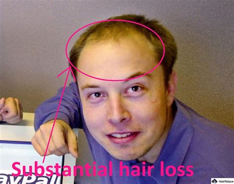 Elon Musk Hair Transplant The Secret Of His Amazing Result
