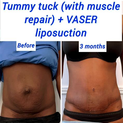 Tummy Tucks Workout