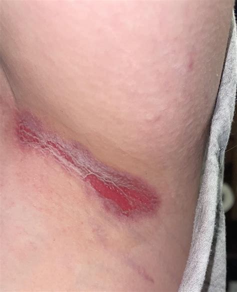Chemical Burns From Deodorant Rmakemesuffer