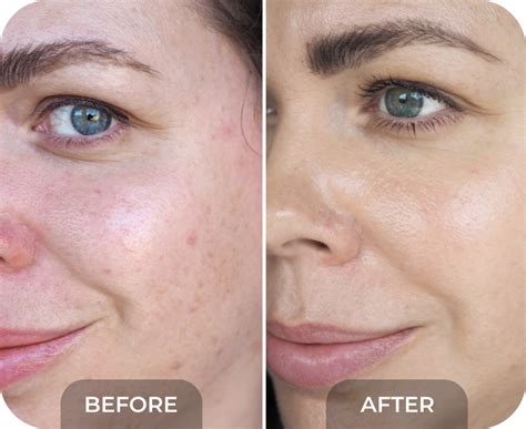 Mydermadream