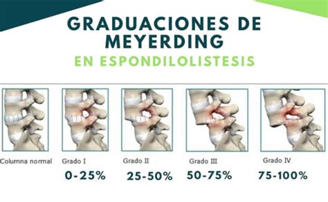 ¿espondilolistesis Lumbar Qué Hago Impuls Clínic