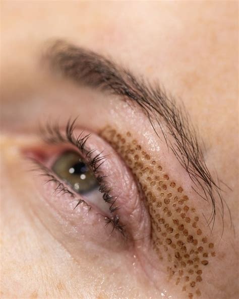 Plexr Blepharoplastie Médicale Sans Chirurgie Des Paupières