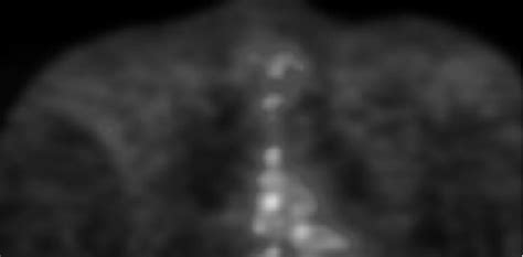 Figure 1 From Petct And Pet Using 18f Fdg In A Patient With Soft