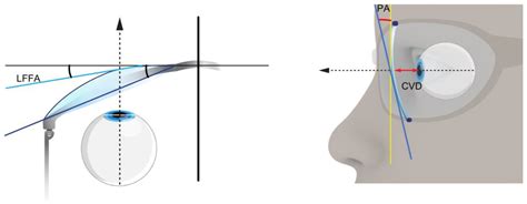 Assessment Of Visual Quality Improvement As A Result Of Spectacle