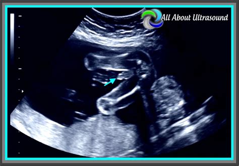 Turtle Sign Ultrasound
